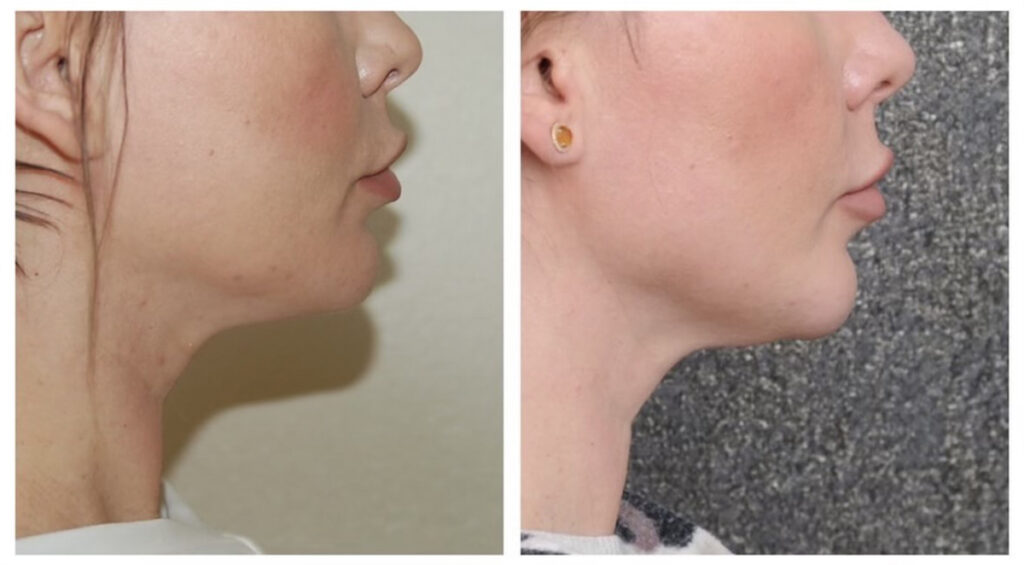 Chin Augmentation & Implants in Gilbert, AZ | DrSkin Plastic Surgery