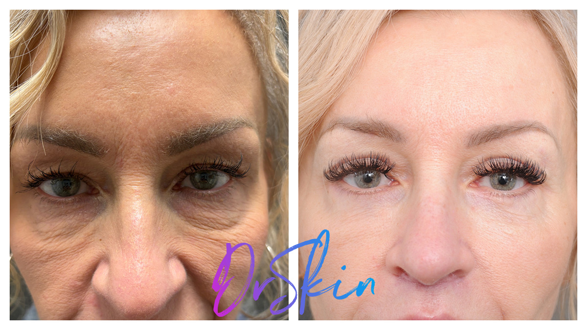 Best Eyelid Lift Surgery Gilbert, AZ | DrSkin Plastic Surgery