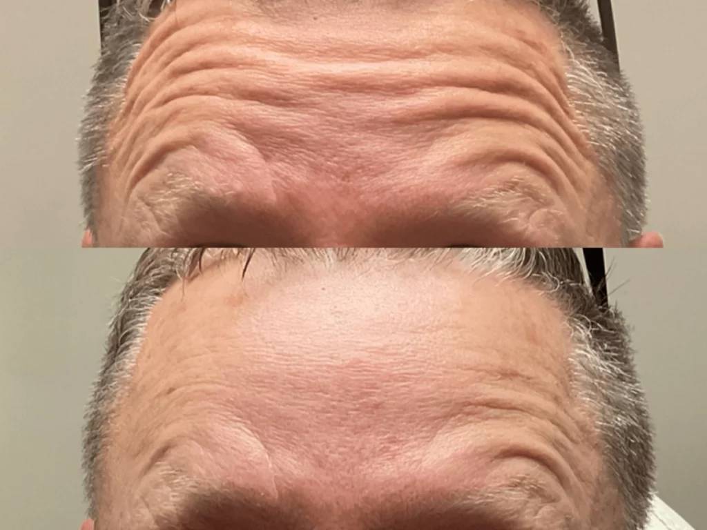 How Many Botox Units Are Needed For Forehead Lines And Lip Lines ...
