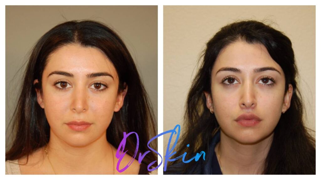 Best Lip Lift Scottsdale, Phoenix, & Gilbert | DrSkin Plastic Surgery