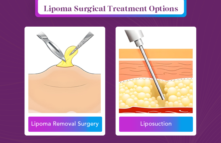 Lipoma Removal in Gilbert, AZ | DrSkin MedSpa and Plastic Surgery